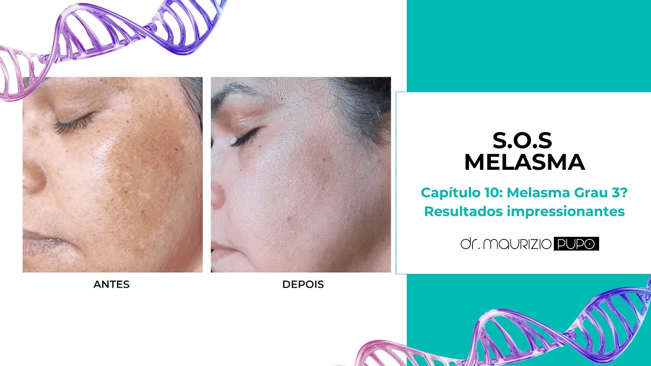 S.O.S Melasma | Capitulo 10: Grau 3 com Manchas Profundas: Como Tratar ...