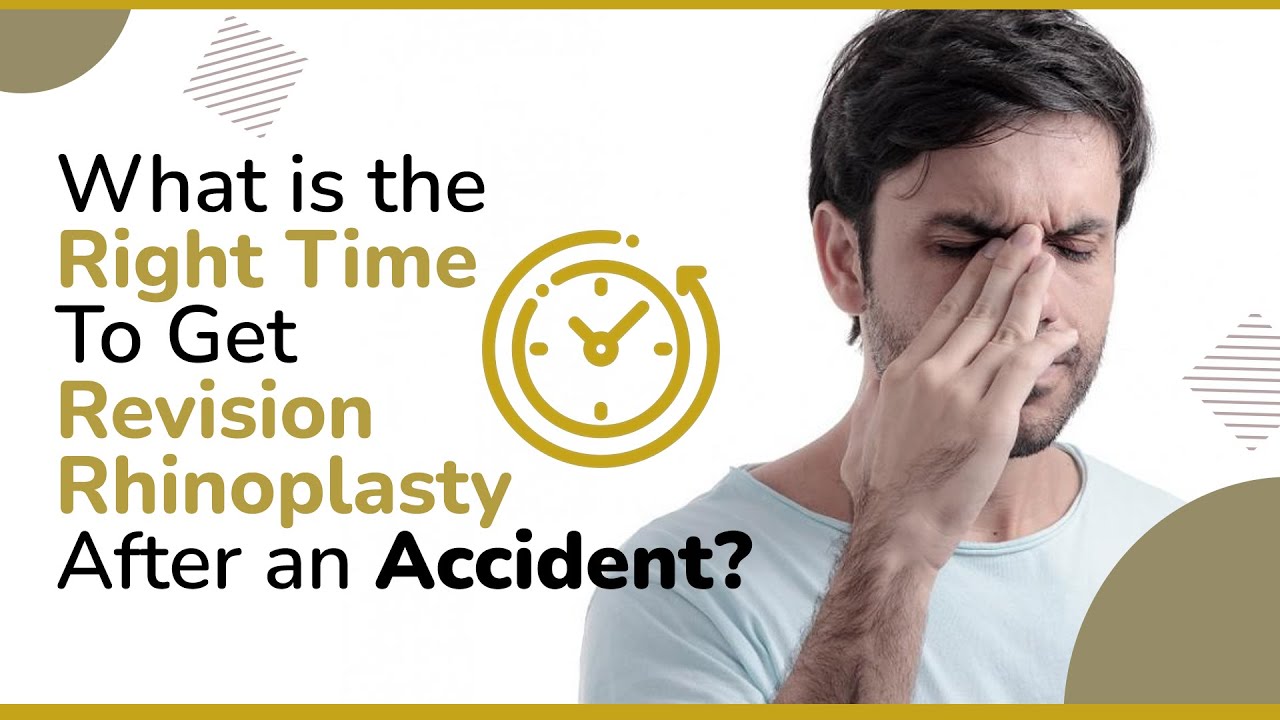 Post Traumatic Nose Correction Rhinoplasty After Accident | Rhinoplasty ...