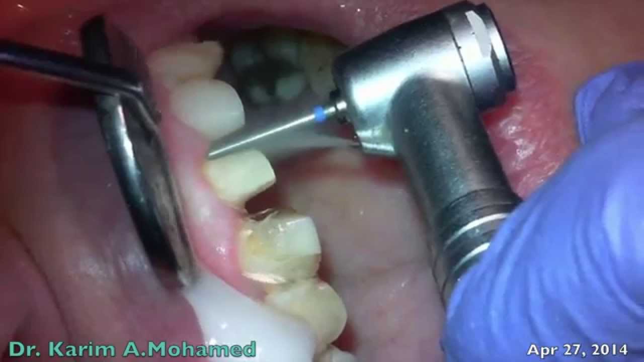 Dental Crown Preparation Sample Video Using Surgical Camera - YouTube