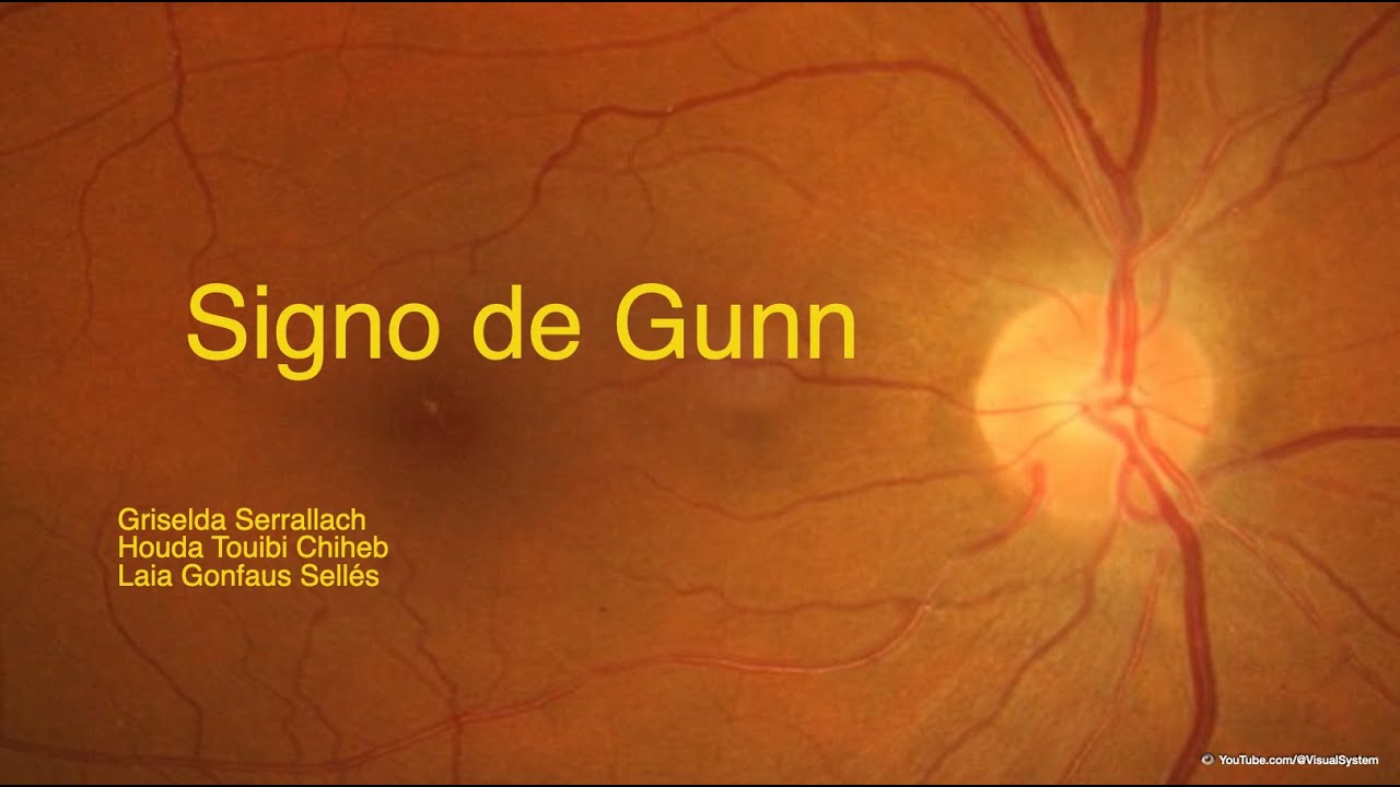Signo de Gunn. - YouTube