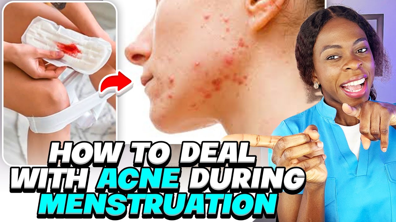 Causes of Acne during menstruation/ how to deal with acne during period ...