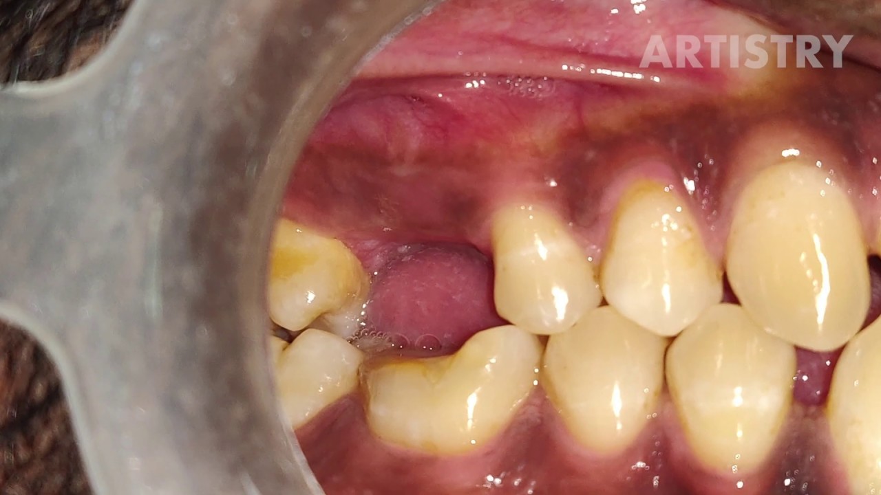 Implant placement in maxillary first molar- 16. Osteotomes used for ...