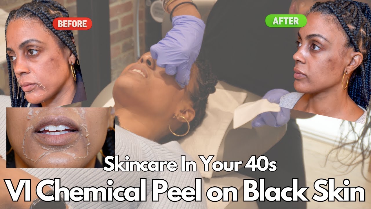 How To Treat Hyperpigmentation and Dark Spots on Black Skin Using A VI ...