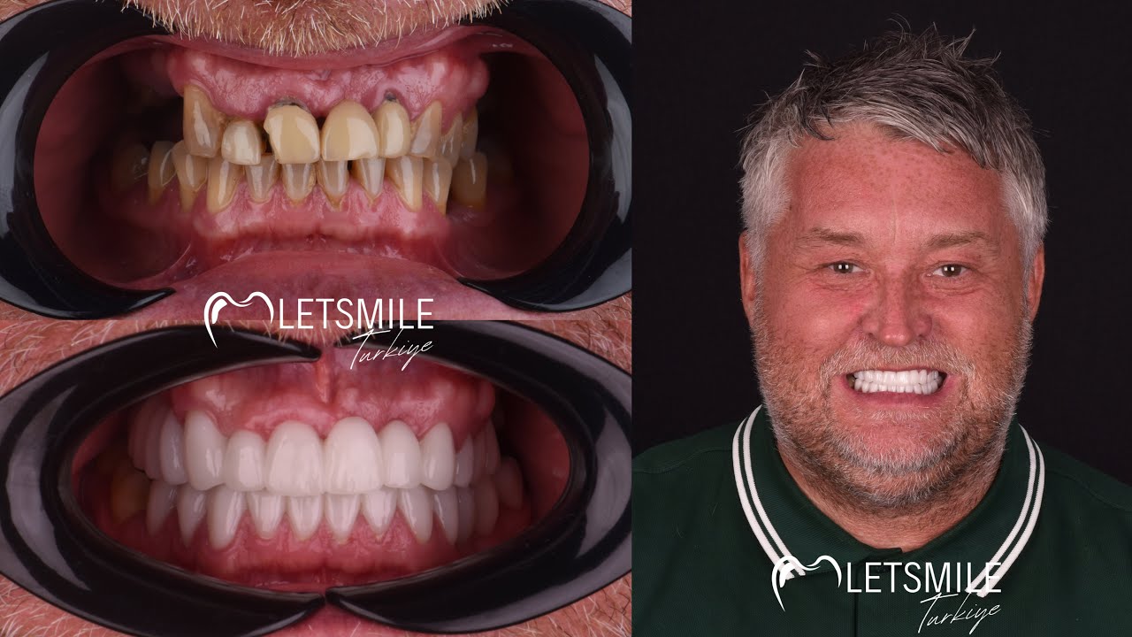 Dental Centre Antalya / Turkey LETSMILE TURKIYE Best Smile Makeover ...
