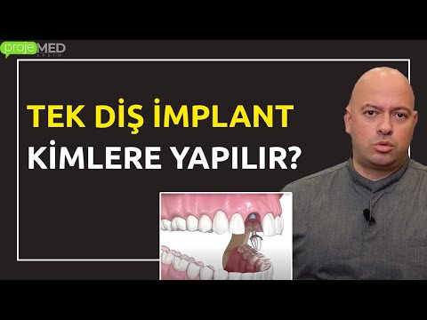 Tek Diş İmplant Nedir ve Nasıl Yapılır? | Tek Diş İmplant Kimlere Yapılır?