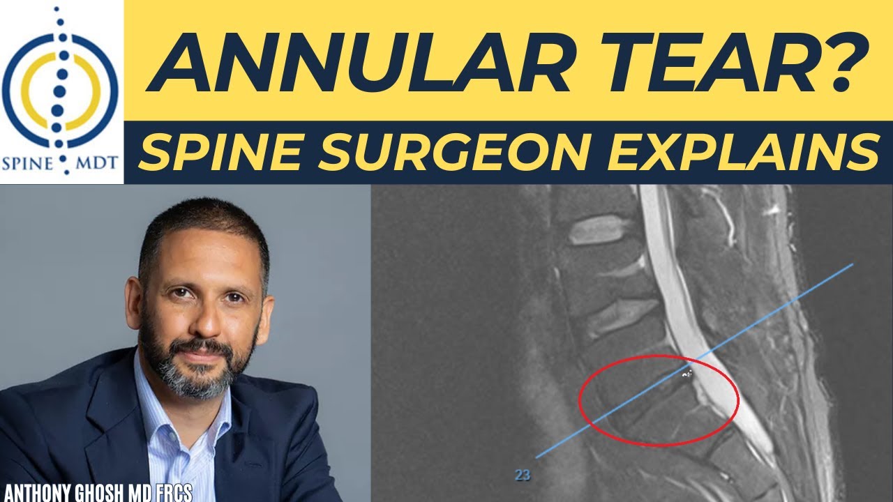 What Is an Annular Tear? Spine Surgeon Explains - YouTube