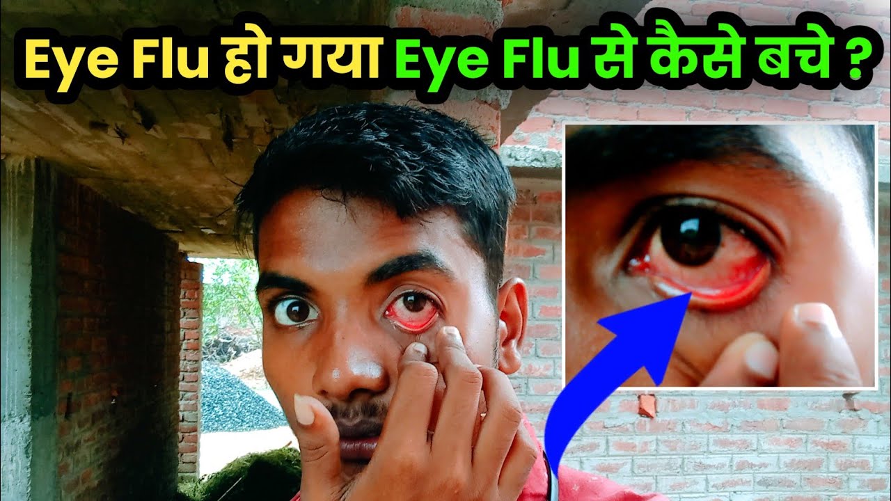 Eye Flu हो गया || Eye Flu से कैसे बचें 🥱 - YouTube