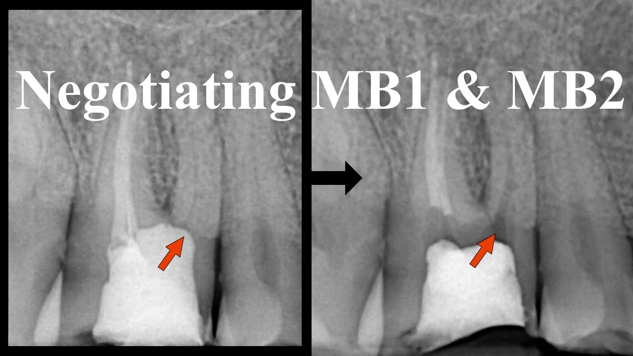 Negotiating MB1 & MB2 canals - YouTube