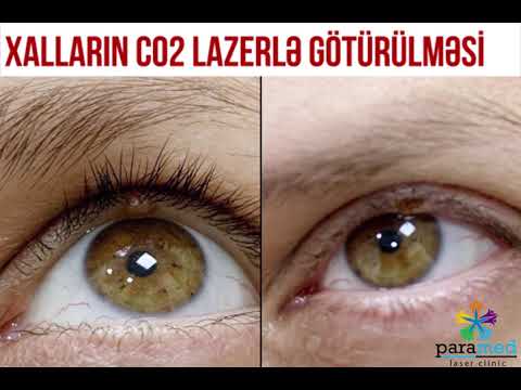 Co2 Lazerlə Göz qapağındakı xalın aradan qaldırılması