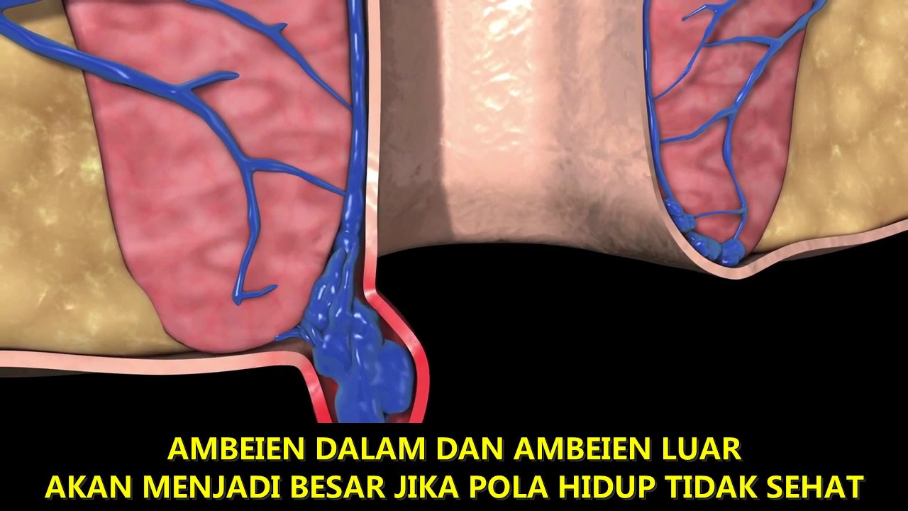 Mengobati Benjolan Ambeien : Dengan Cepat dan aman tanpa Operasi - YouTube