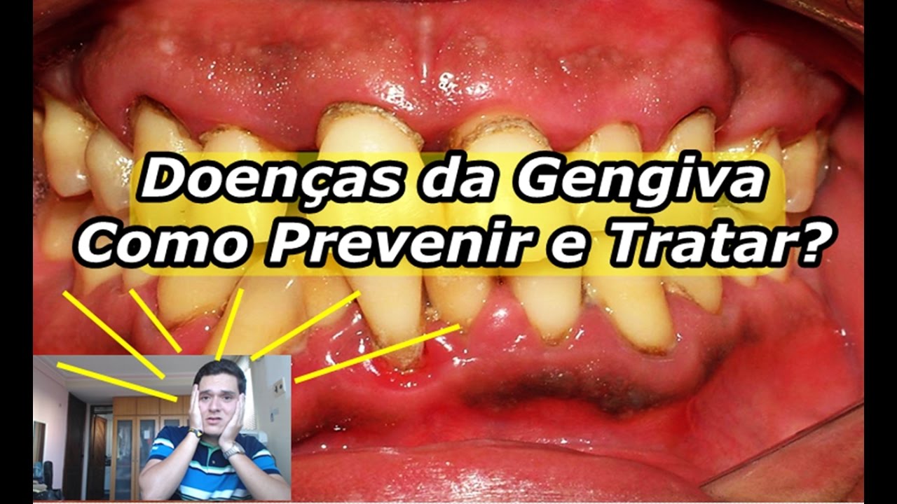 Doenças da Gengiva - O Que é? Como prevenir e tratar? (RESUMO) - YouTube