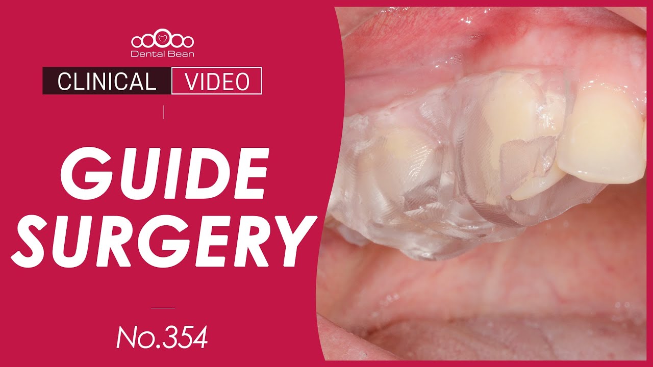 #15 implant placement with guide surgery [Dr. Na Kiwon] - YouTube