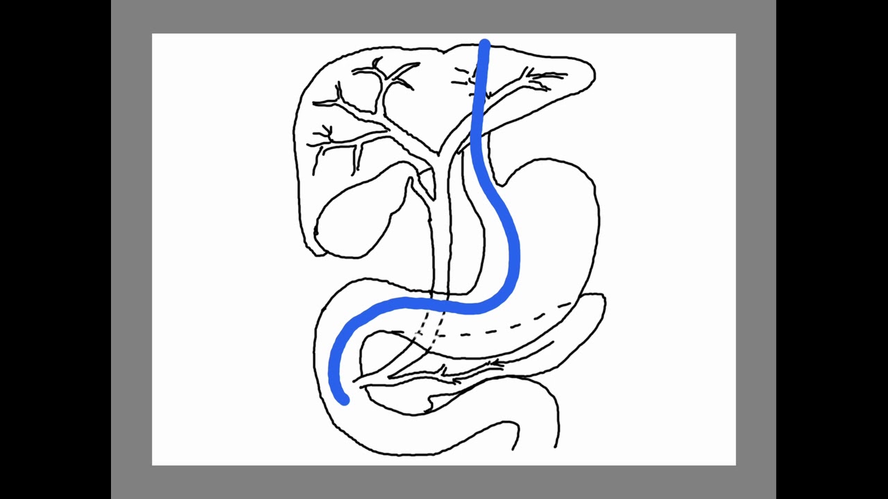 JAA Papilotomia endoscopica esquema explicativo - YouTube