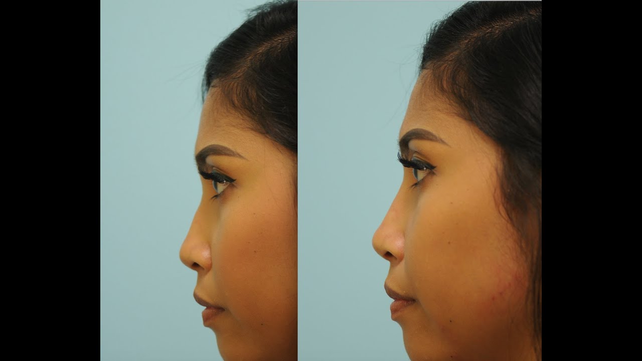 Injectable Rhinoplasty with Cannula by Dr. Sam Lam - YouTube