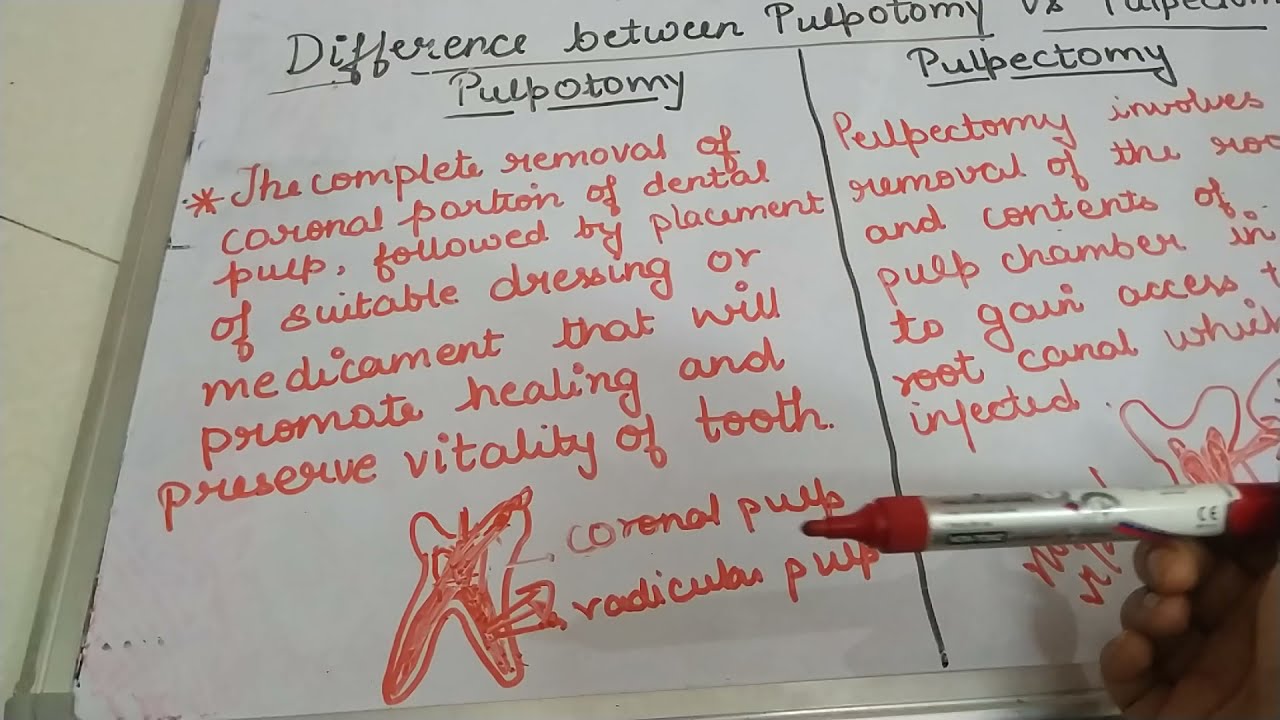 Difference between pulpotomy and pulpectomy#pedodontics - YouTube