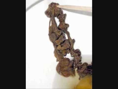 Mucoid Plaque - YouTube