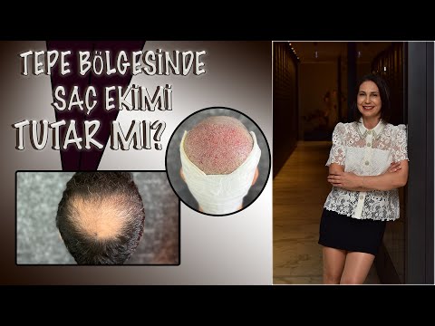 Tepe Bölgesinde saç ekimi Tutar mı?