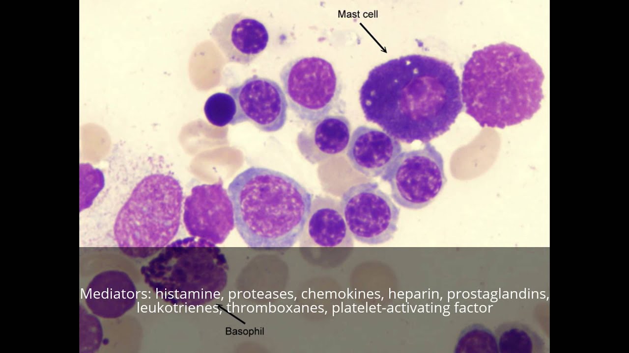 Mastocytosis Information - YouTube