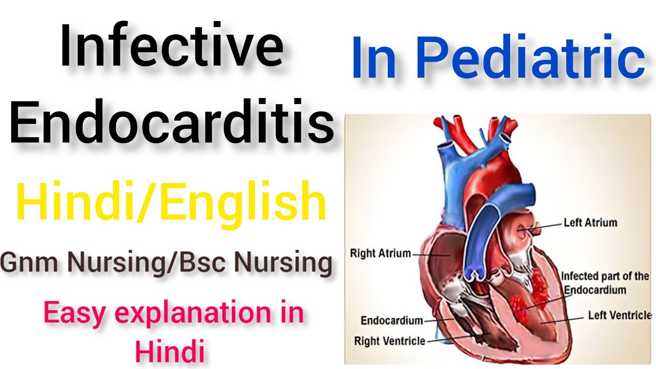 Infective Endocarditis|| in Pediatric|| easy explanation||for GNM and ...