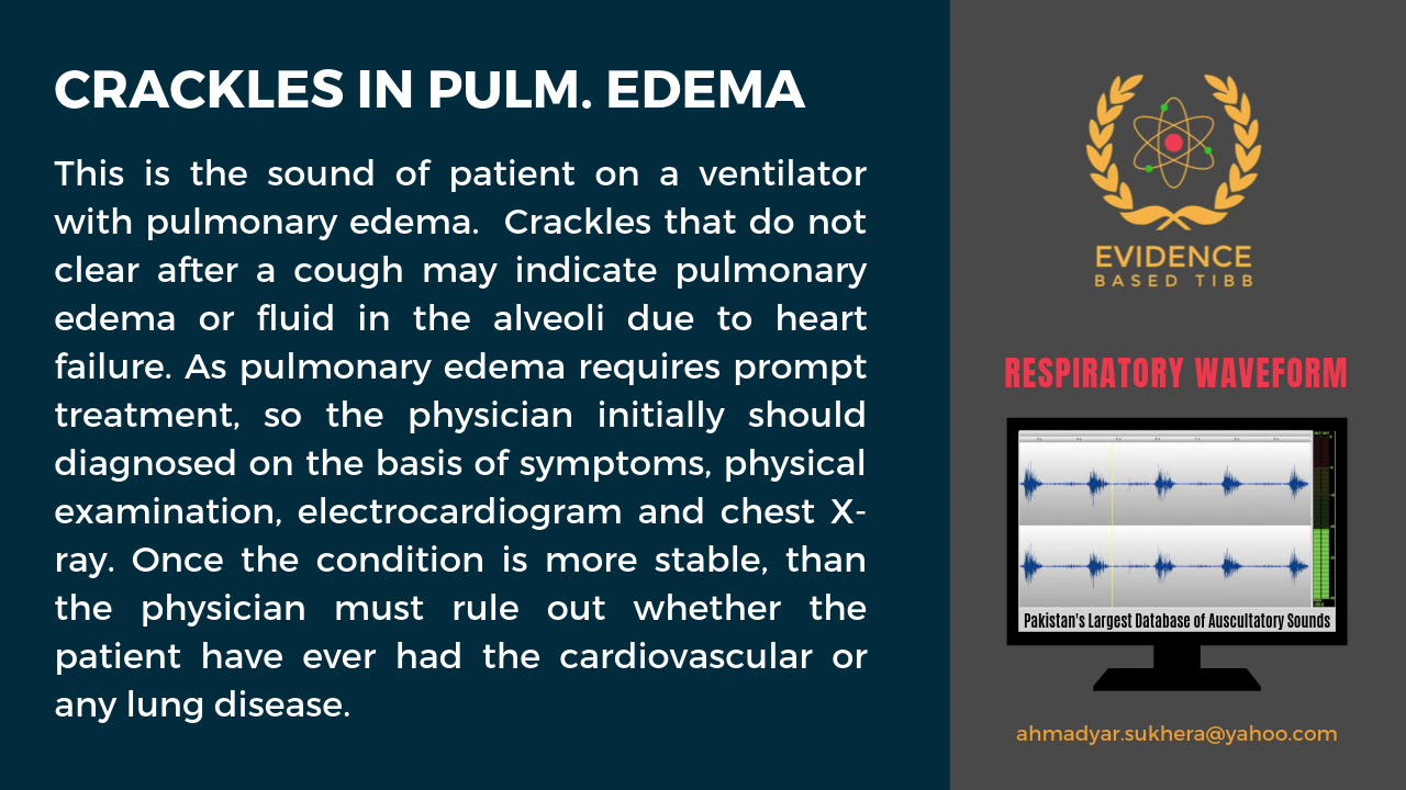 CRACKLES IN PULMONARY EDEMA | PULMONARY SOUNDS | PROJECT CPAT | DOCTOR ...