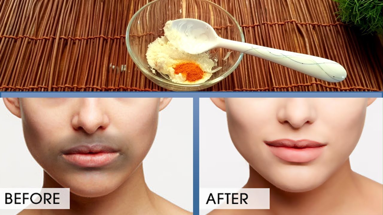 Remove Darkness Around Mouth Lips Black Spots Hyper pigmentation remove-darkness-around-mouth-lips-black-spots-hyper-pigmentation