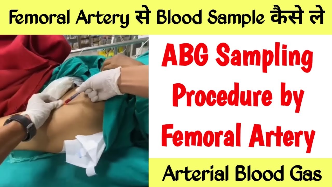 Femoral Artery से Blood कैसे लेते हैं || ABG Sampling Procedure by Femoral Artery || # ...