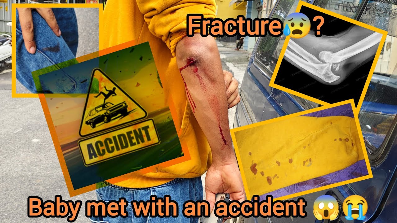 Heng aythu yar madidu🥲|just miss gotha🩹 #shiran ️🧿 #fracture #bones # ...