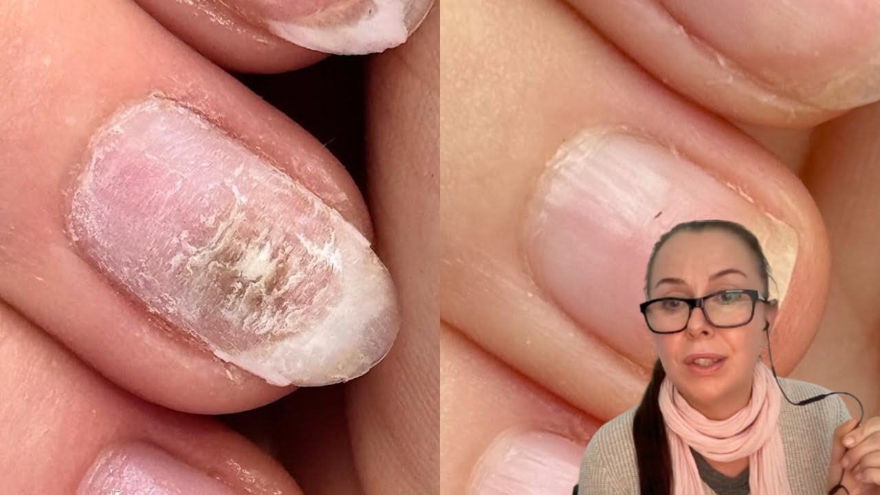 Update on the green nail problem. [bacterial infection under gel] 🦠 ...