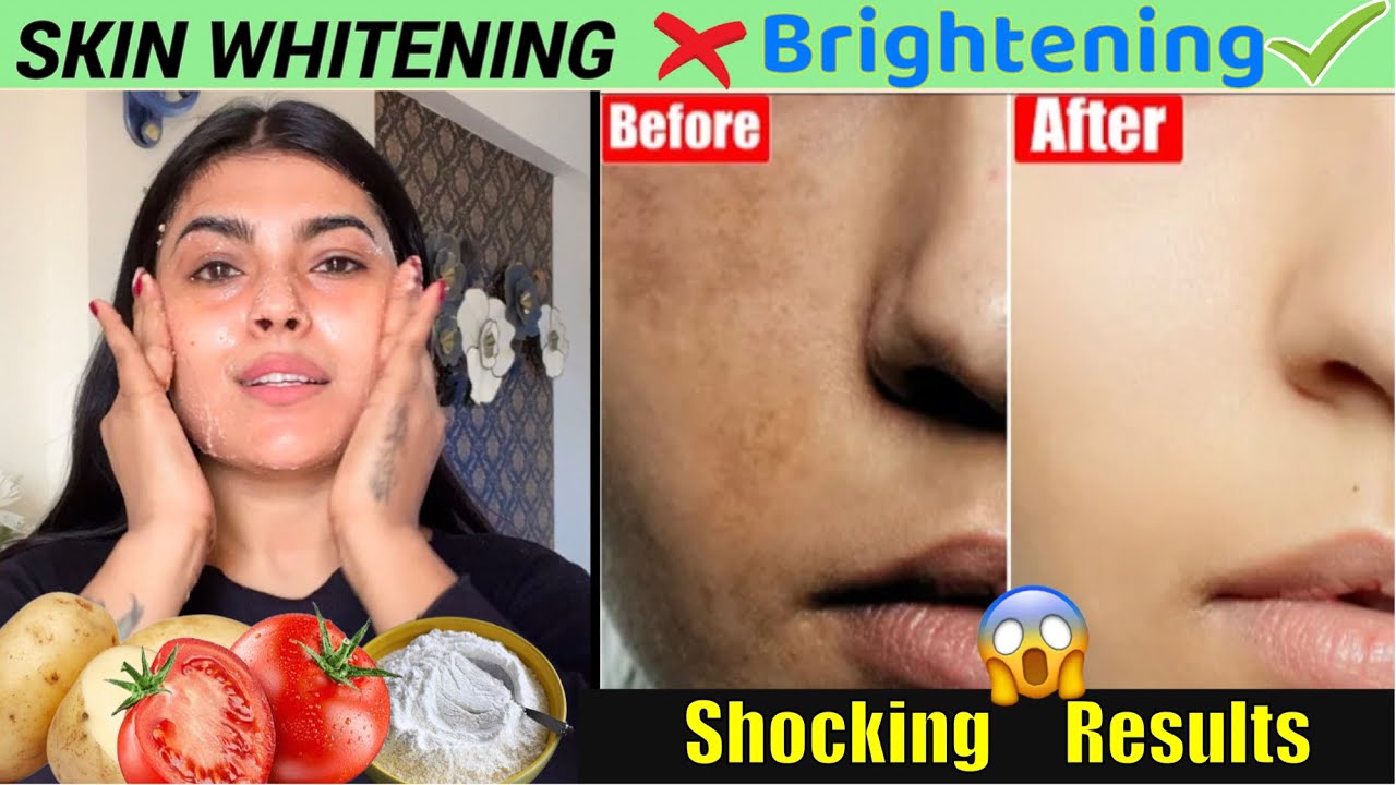 I applied these 2 DIYs on my Dark & Dull face and got Brighten and ...