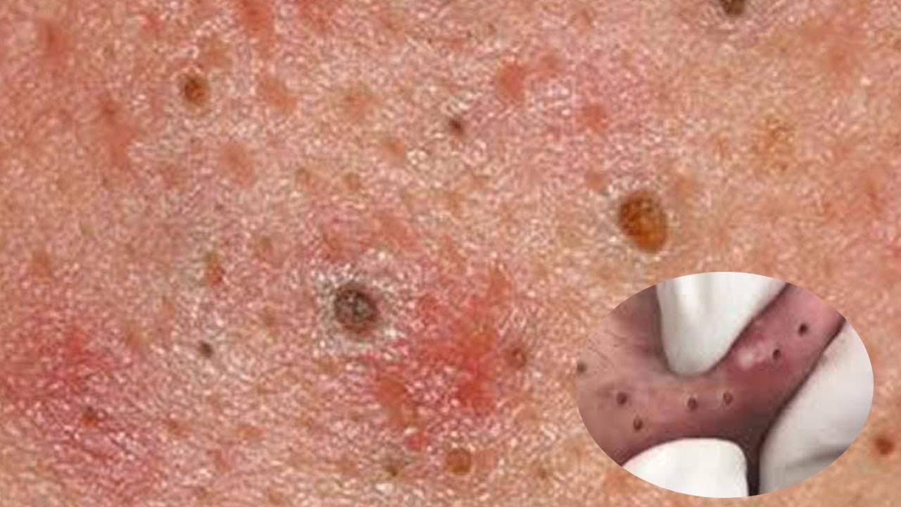 How To Treat Acne \\ Acne Treatment - YouTube
