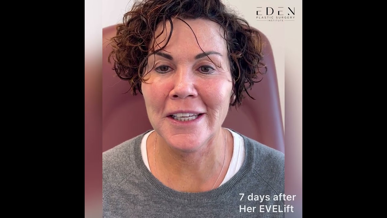 EVELift Facelift Patient Testimonial | Dr. Ali Charafeddine Eden ...