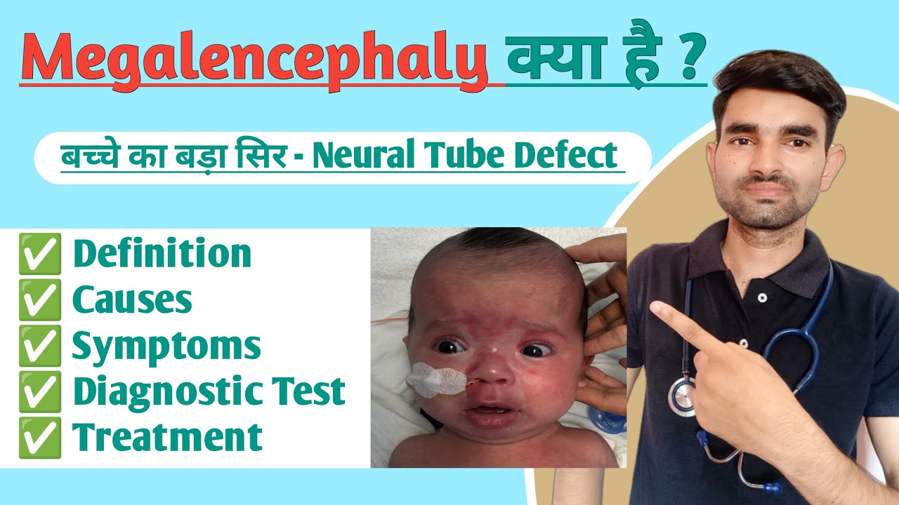 Megalencephaly in Hindi | Causes, Symptoms And Treatment of ...
