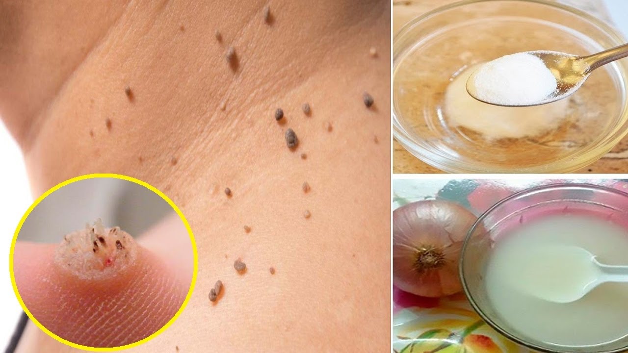 How To Get Rid Of Warts Naturally \\ Warts Removal - YouTube