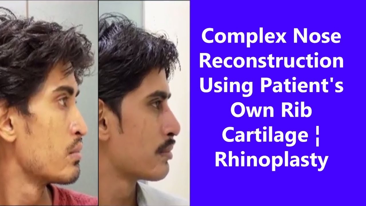 Nose Reconstruction with Rib Cartilage | Complex Rhinoplasty | The ...