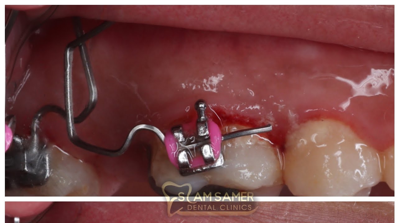 space regainer by Wire bending Dr Eslam Samir - YouTube