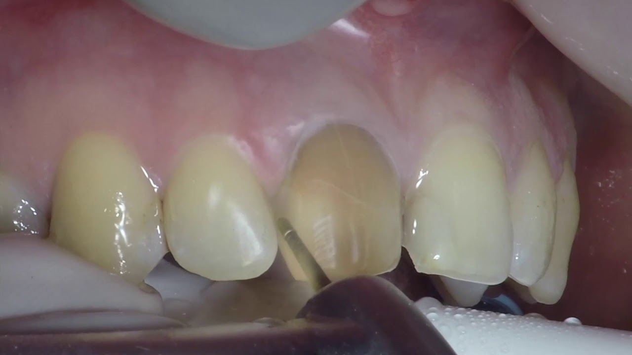 Porcelain veneers preparation/p.176 - YouTube