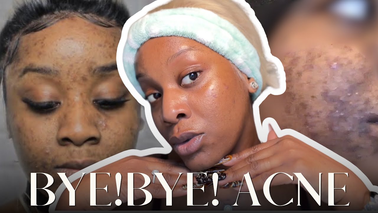 ROUTINE CONTRE L'ACNE | BYE!!! LES TACHES ET BOUTONS | ROUTINE ACNÉ ...