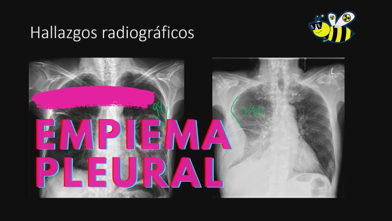 Empiema Pleural - YouTube