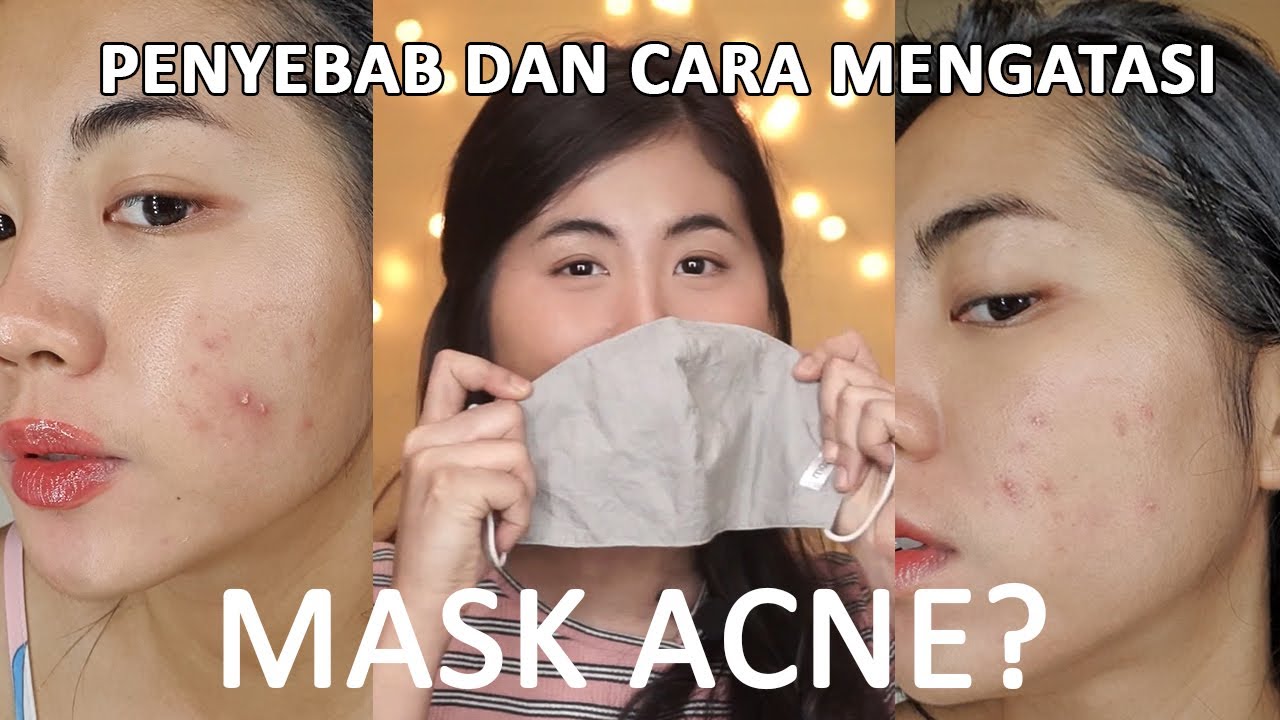 MASKNE : jerawat akibat masker. Gak perlu produk khusus, pahami ini aja ...