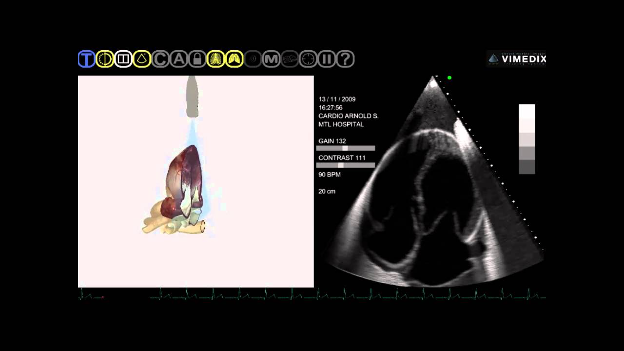 Realidade Virtual Medicina - Vimedix Ecocardiografia Transtorácica ...