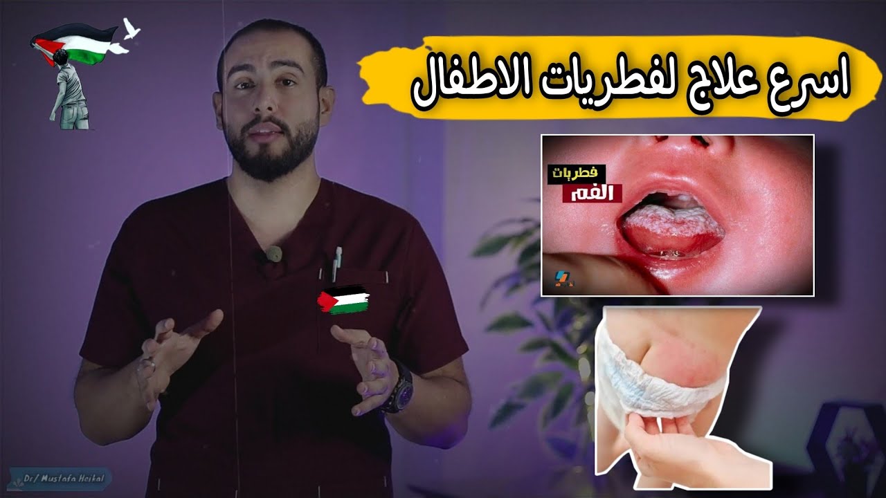 علاج فطريات الفم واللسان عند الاطفال اسرع علاج لفطريات الاطفال