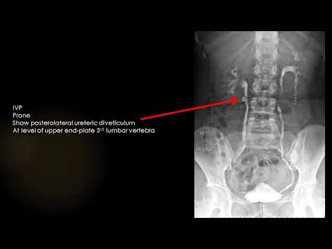 CASE 842  IVP ureteric diveticulum,stricture