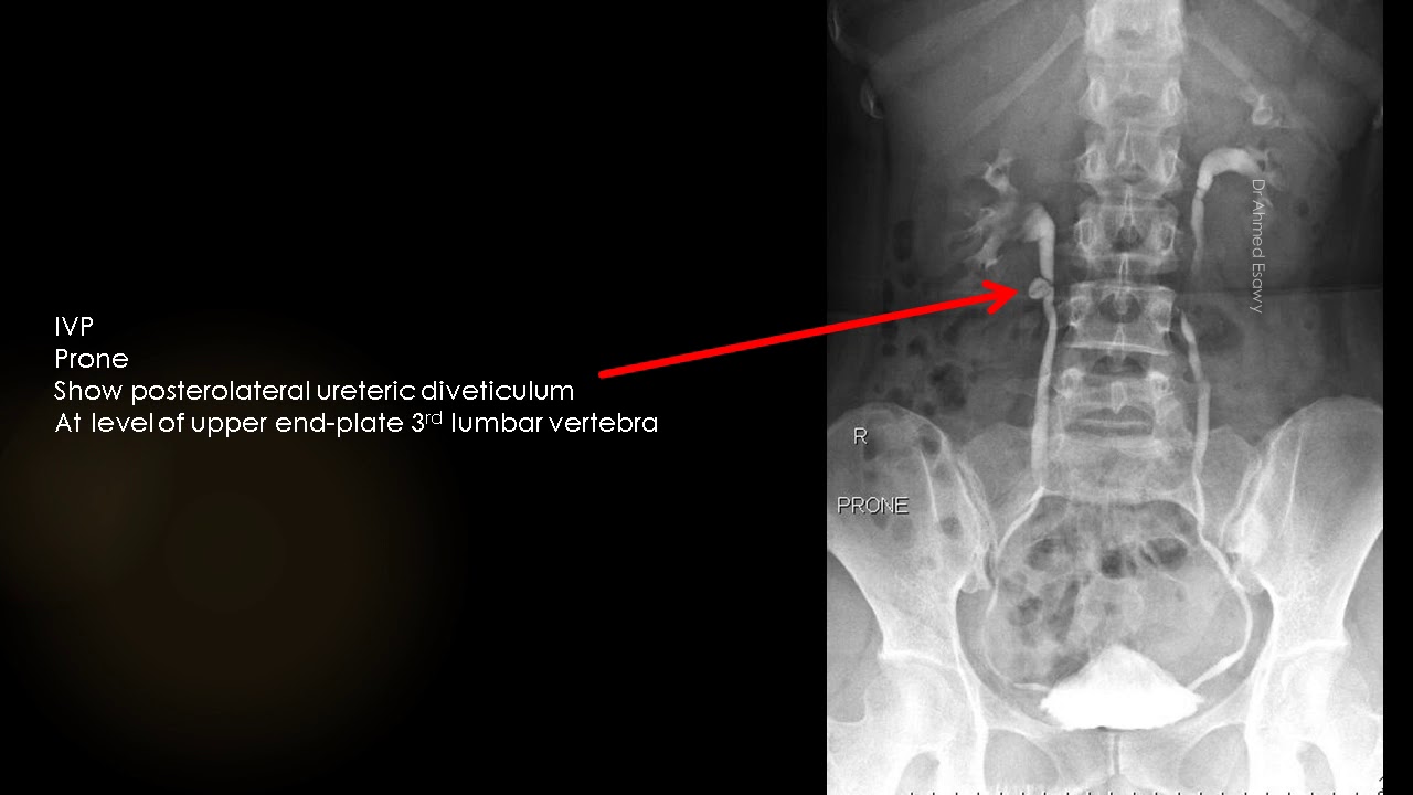 CASE 842 IVP ureteric diveticulum,stricture - YouTube