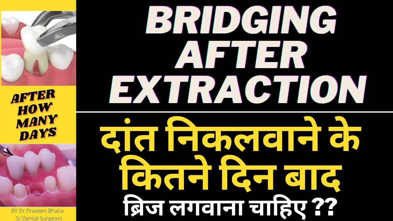 दांत निकलवाने के कितने दिन बाद ब्रिज लगवाएं -BRIDGE AFTER EXTRACTION ...