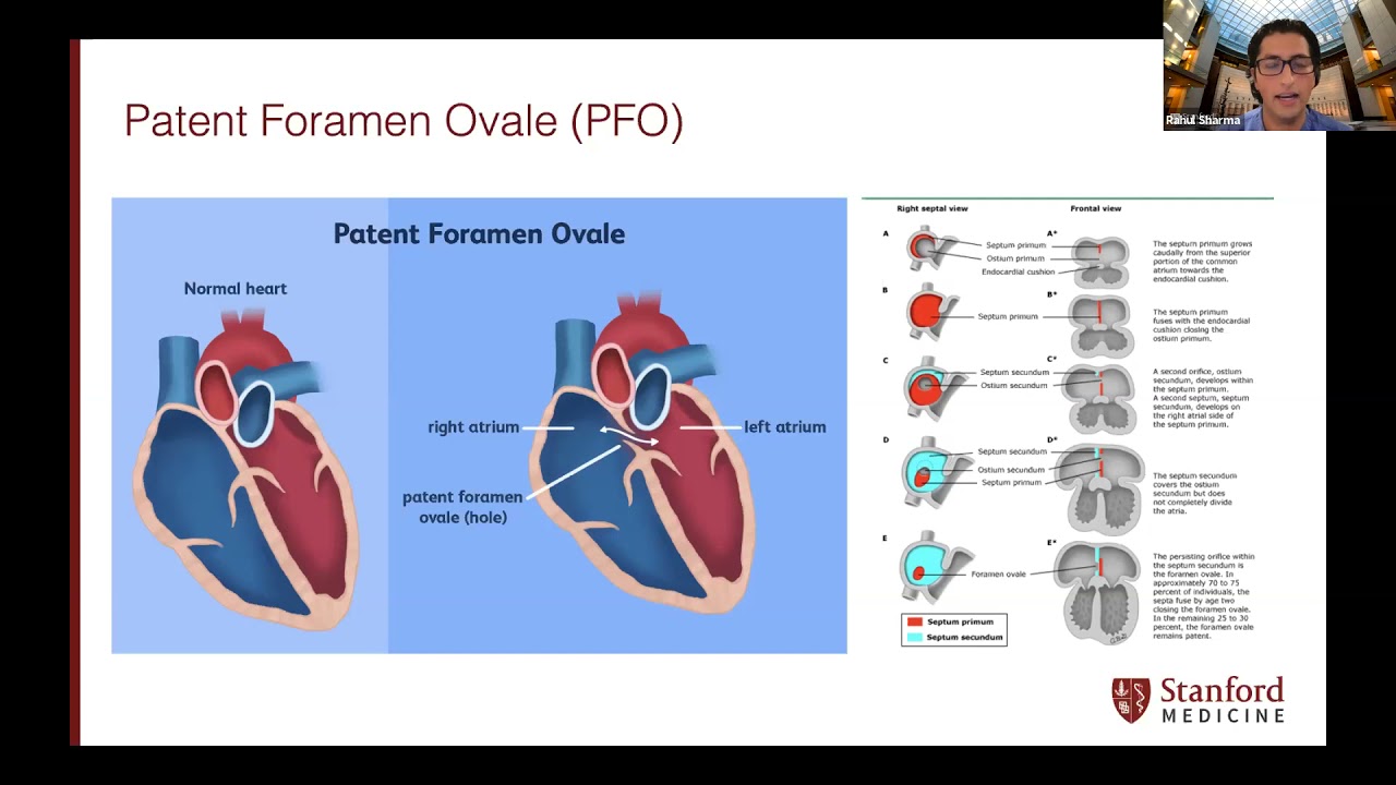 Structural Interventions in Cardiology | Stanford Department of ...