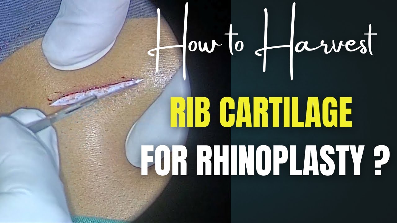 RIB CARTILAGE HARVEST FOR RHINOPLASTY | Dr. Souvik Mondal | ENT ...