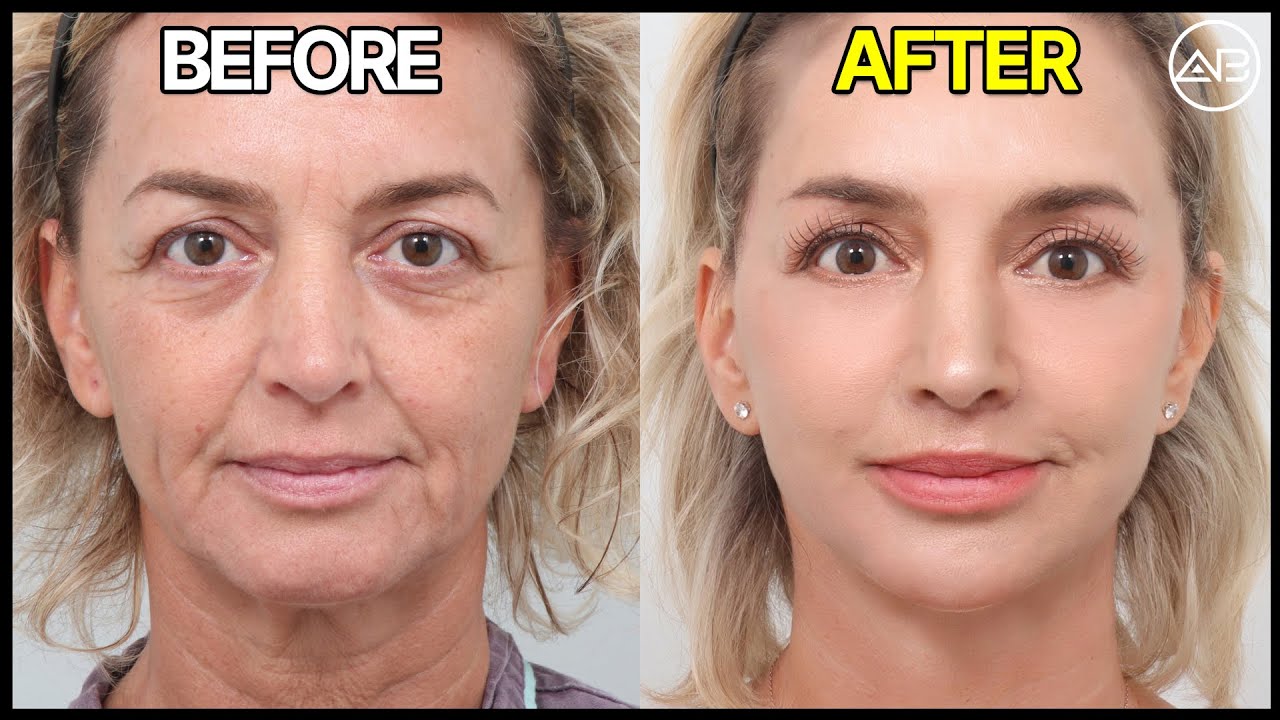 Facelift Transformation: Look 10 Years Younger! | Before & After | AB ...