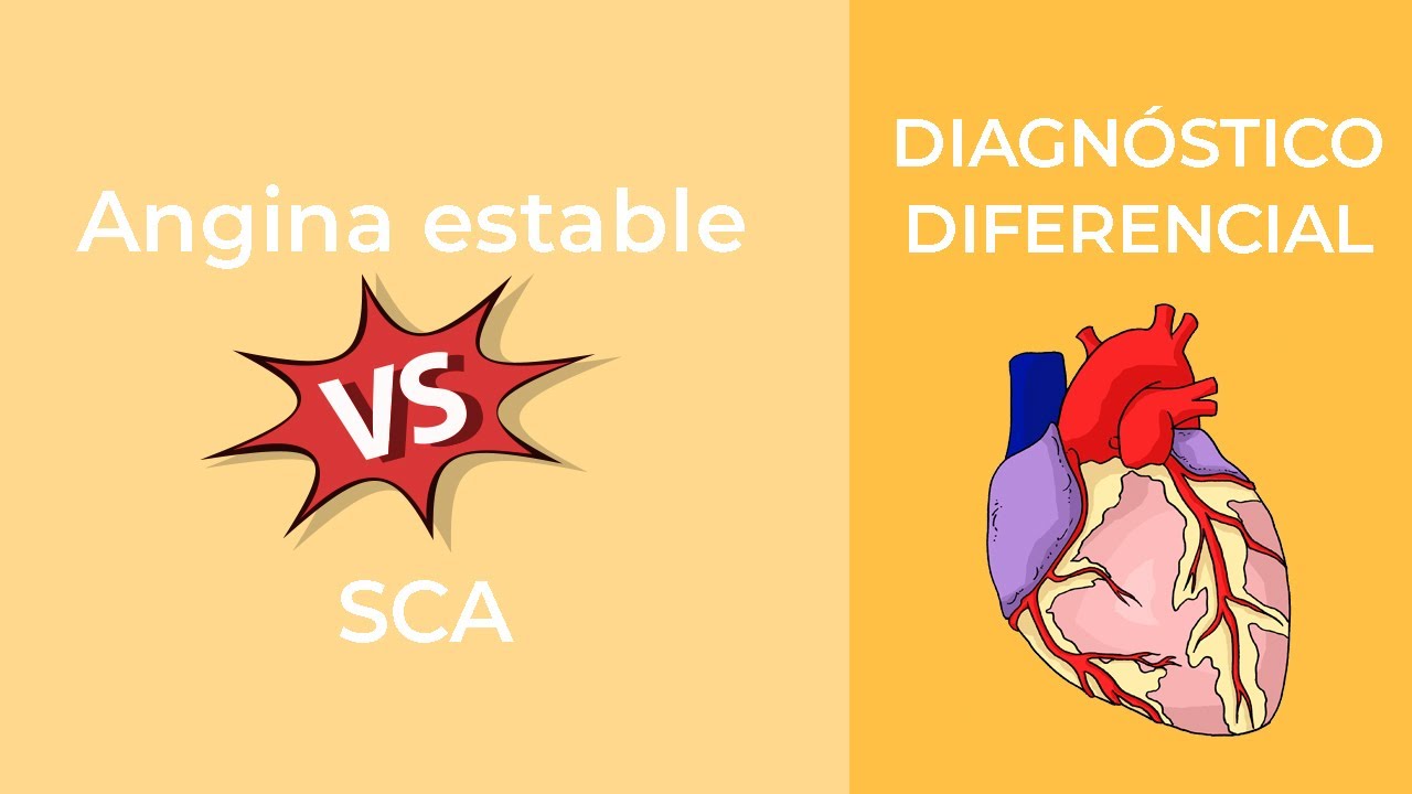 Diagnóstico Diferencial Angina estable vs SCA - YouTube