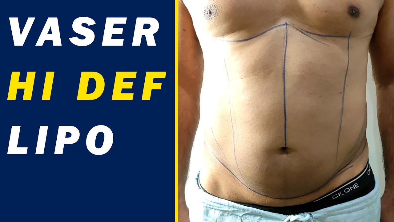 360 degree Abdomen liposuction - YouTube