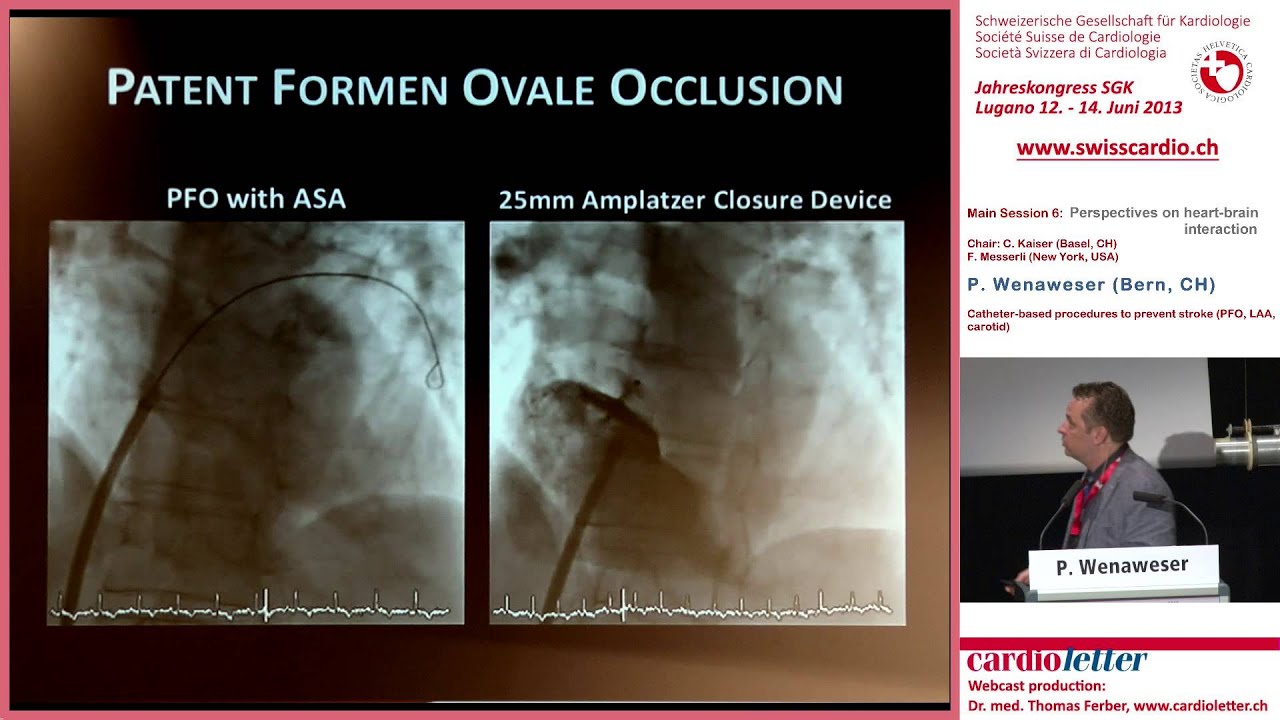 P. Wenaweser (Bern, CH): Catheter-based procedures to prevent stroke ...